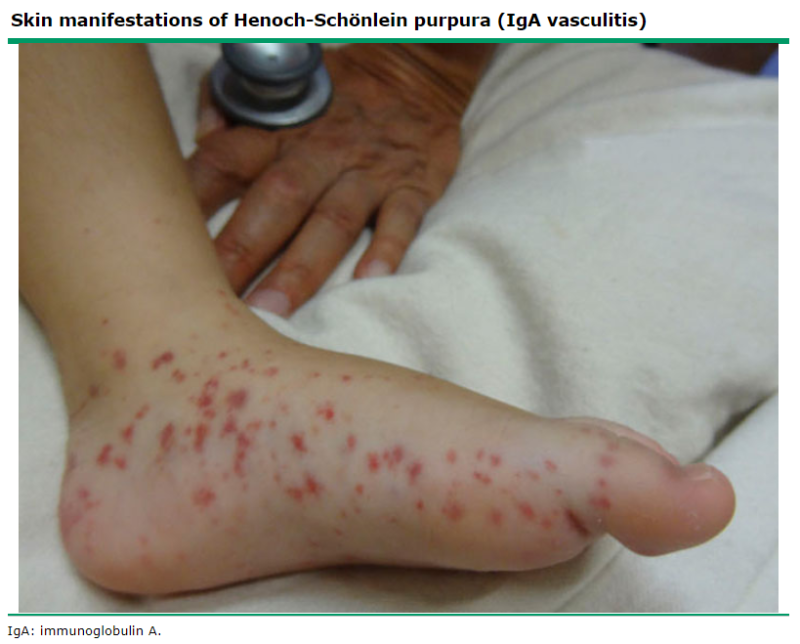 IgA 혈관염, 발진, IgA vasculitis (Henoch-Schönlein purpura), rash : 네이버 블로그