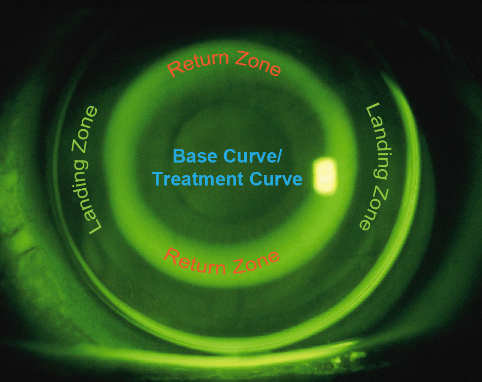 파라곤 CRT 드림렌즈의 장점은? : 네이버 블로그