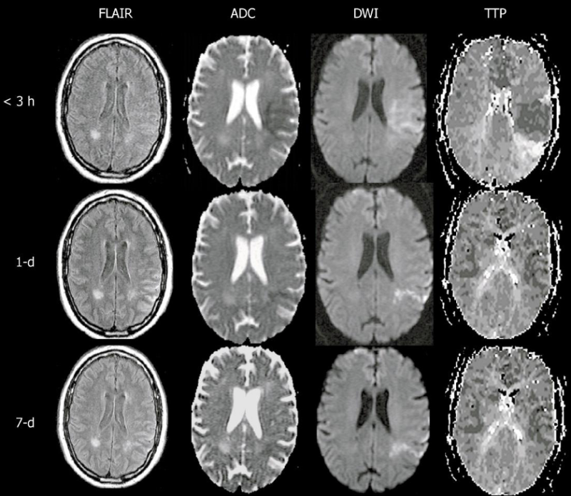 뇌경색의 MRI imaging : Diffussion, ADC map, Perfusion(MTP,TTP) : 네이버 블로그