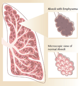 만성 폐쇄성 폐질환 COPD (chronic obstructive pulmonary disease) 원인, 증상, 치료, 간호 ...