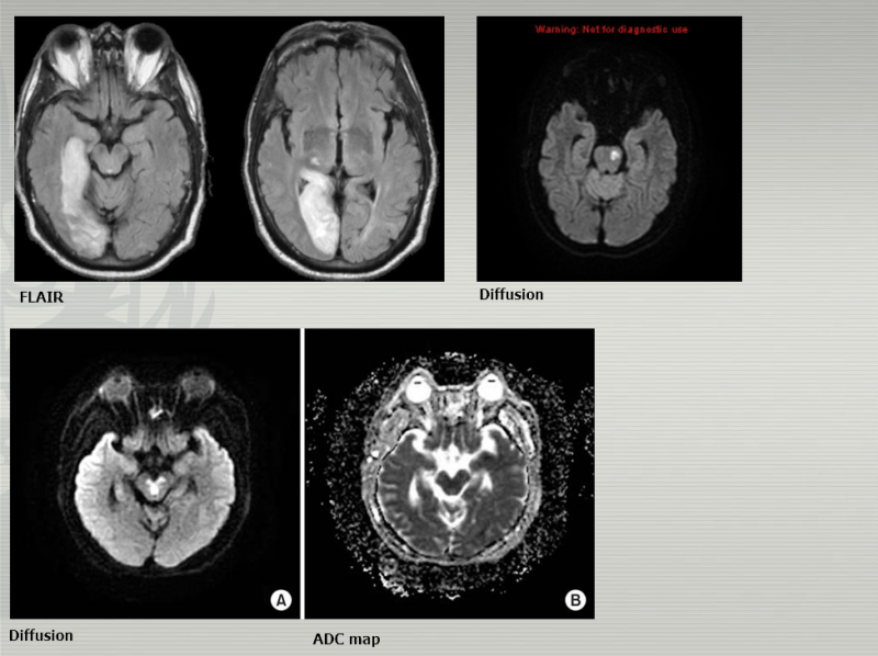 뇌경색의 MRI imaging : Diffussion, ADC map, Perfusion(MTP,TTP) : 네이버 블로그
