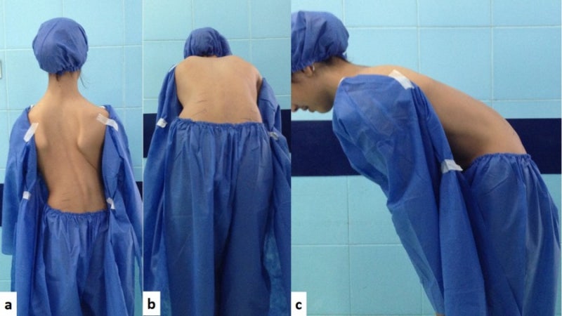 통증회피자세 (Antalgic posture) / 척추측만증 (scoliosis) : 네이버 블로그