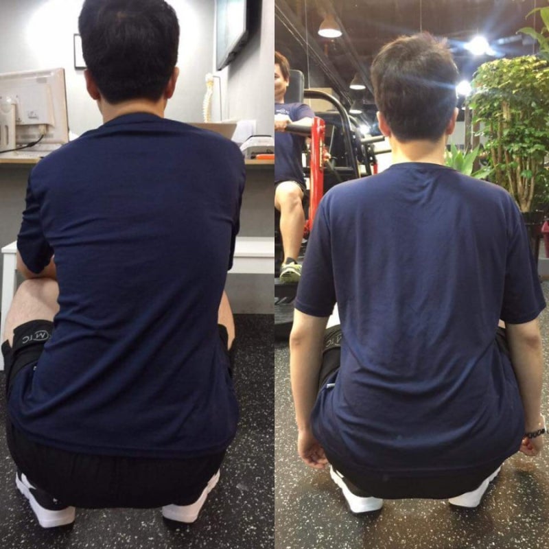 통증회피자세 (Antalgic posture) / 척추측만증 (scoliosis) : 네이버 블로그