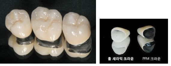어금니 충치치료 단계별 증상 알아보기 네이버 블로그