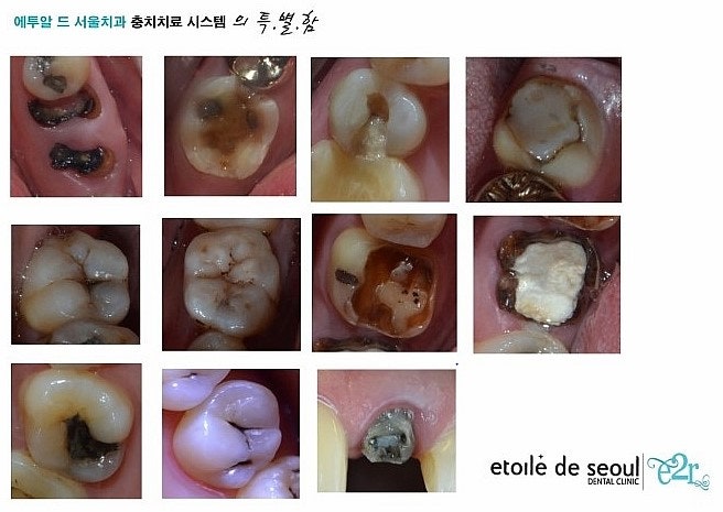 어금니 충치치료 단계별 증상 알아보기 네이버 블로그