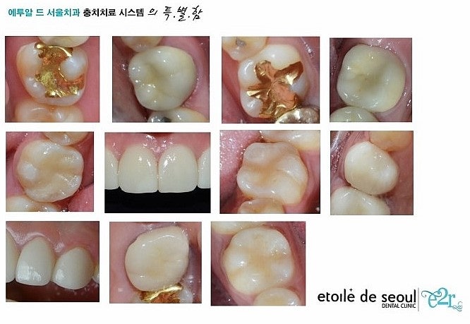 어금니 충치치료 단계별 증상 알아보기 네이버 블로그