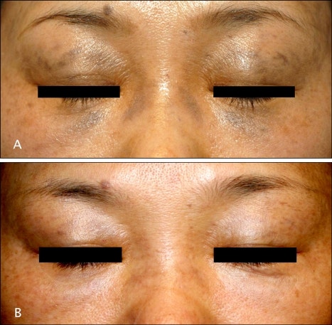 [ 색소 치료 ] 기미가 아니라고요? 후천성 양측성 오타모반양 반점 (ABNOM) - 석촌동, 송파동, 가락동 헬리오시티피부과 ...