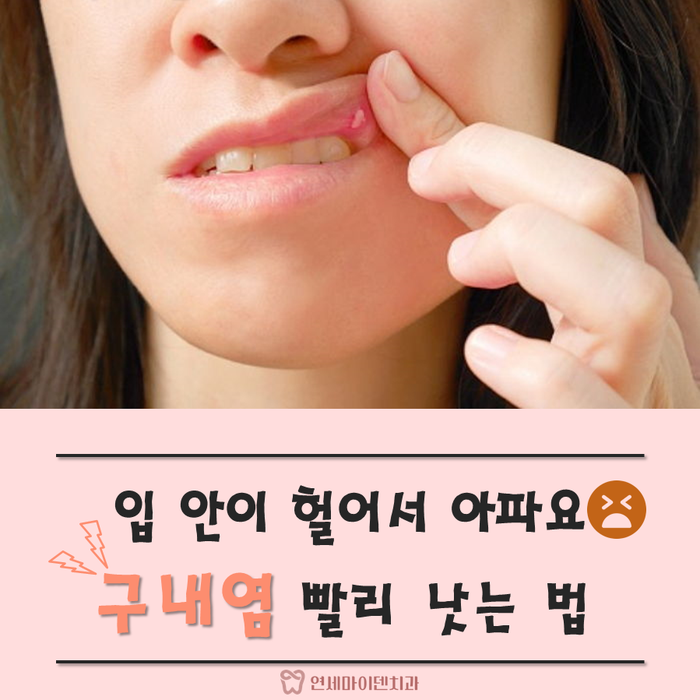 구내염 빨리낫는법종류 치료법 예방법 입 안이 헐어서 아파요 네이버 블로그