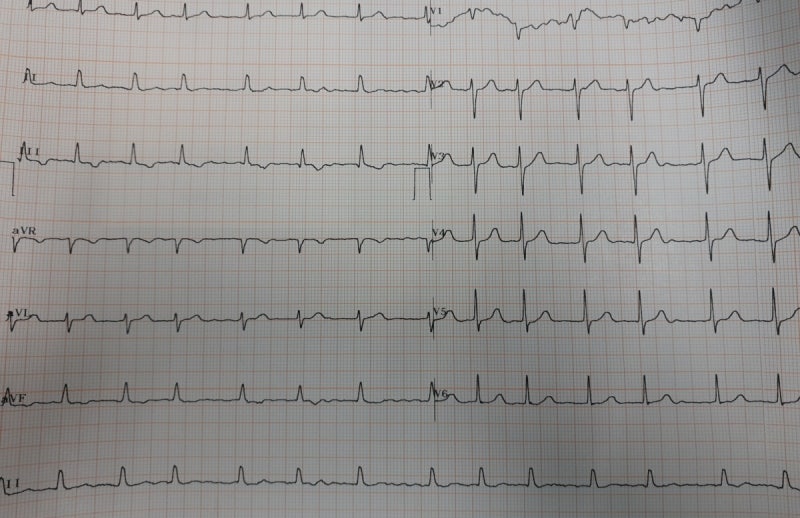 정신과에서 불면증, 두근거림으로 처방받던 환자, 혈압약 복용중 혈액검사 등 평가, 심부전 증상과 부종을 동반한 심방세동 확인 ...