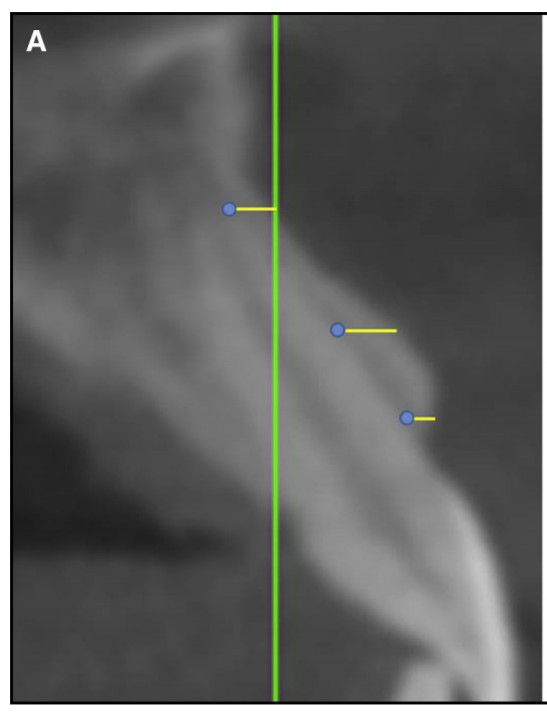 눈으로 배우는 교정 세미나- A point,ceph tracing : 네이버 블로그