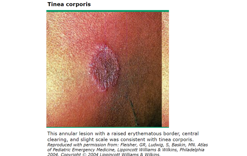 3-4개월 동안의 가려움을 동반한 국소 피부 질환; 체부백선, 완선, tinea corporis, cruris : 네이버 블로그