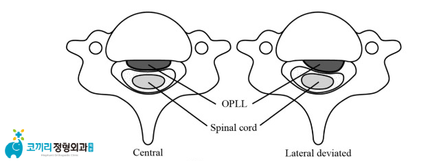 김해프롤로치료하는병원 - 후종인대골화증(Ossification of Posterior Longitudinal Ligament ...