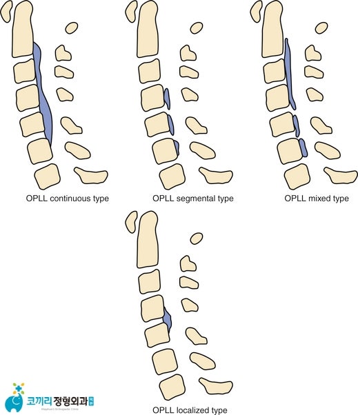김해프롤로치료하는병원 - 후종인대골화증(Ossification of Posterior Longitudinal Ligament ...