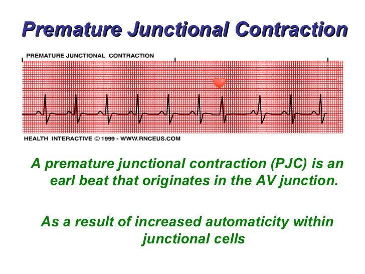 PJC, premature junctional rhythm, 방실연접부성 조기수축 : 네이버 블로그