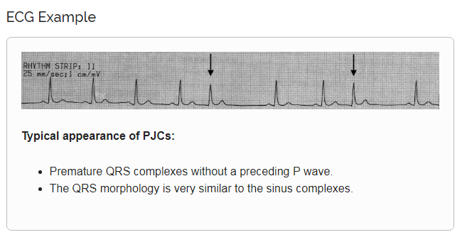 PJC, premature junctional rhythm, 방실연접부성 조기수축 : 네이버 블로그
