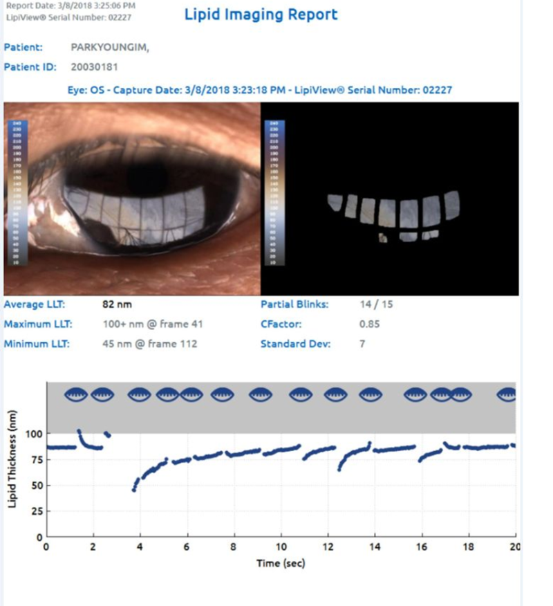 아이윤병원/리피뷰(Lipiview)와 리피플로우(Lipiflow) : 네이버 블로그