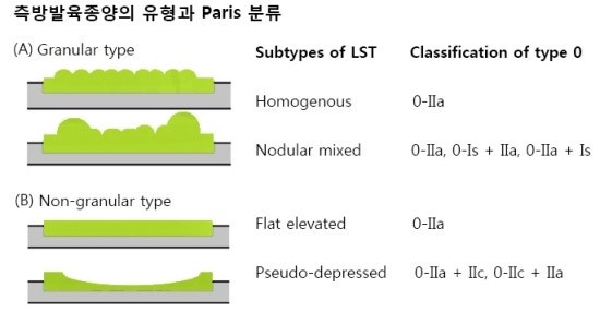 대장 용종의 치료 원칙, 측방발육종양을 중심으로 : 네이버 블로그