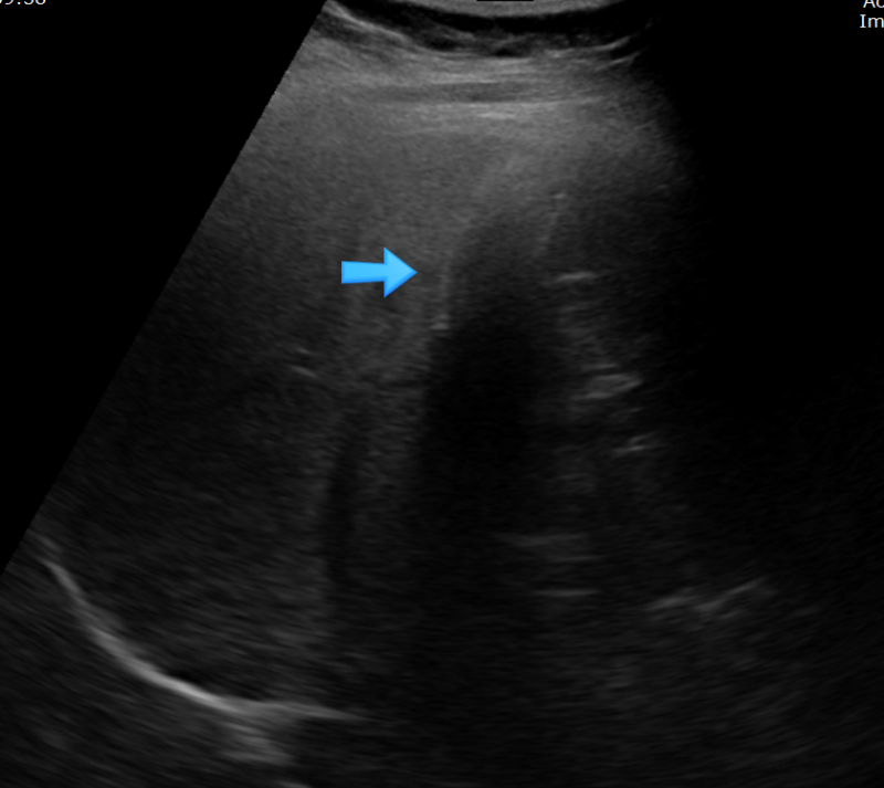 담낭이 잘 관찰되지 않고 wall-echo-shadow (WES) 가 의심, (담석으로 가득찬 담낭, 만성 담낭염 ...