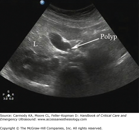 담낭이 잘 관찰되지 않고 wall-echo-shadow (WES) 가 의심, (담석으로 가득찬 담낭, 만성 담낭염 ...