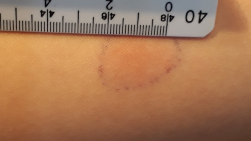 결핵검사 PPD skin test (TST검사)시행-강남대치동유학생검진 : 네이버 블로그