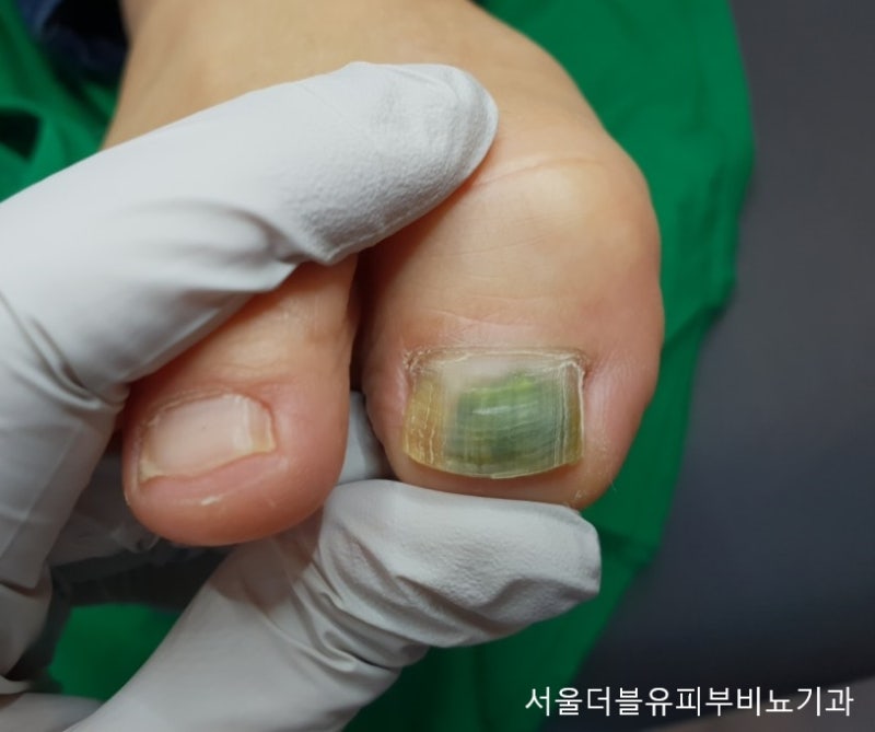 [대구 현풍 테크노폴리스 피부과] 녹색조갑증후군 (Green nail syndrome) [고령/창녕/합천/논공/구지] - 서울 ...