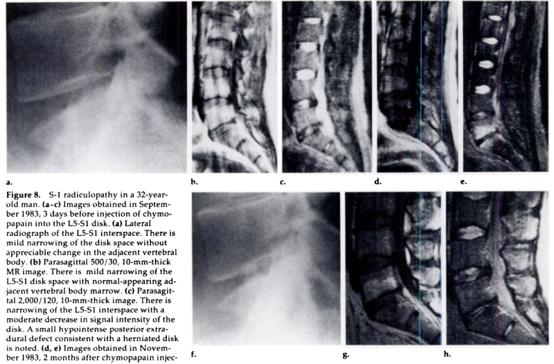 [MRI] Modic changes? : 네이버 블로그