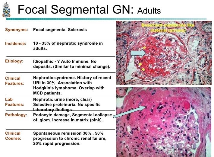 신장이식수술 후 국소분절성 사구체경화증(FSGS : Focal Segmental Glomerulosclerosis)의 재발 ...