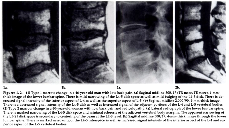 [MRI] Modic changes? : 네이버 블로그