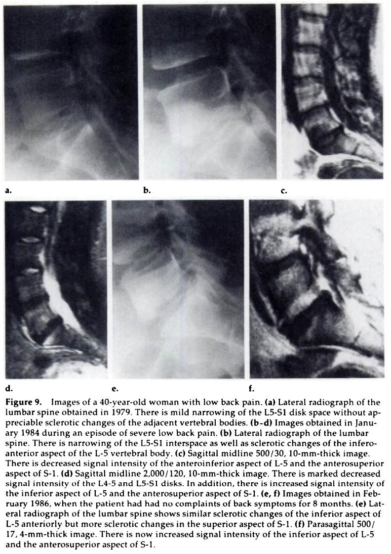 [MRI] Modic changes? : 네이버 블로그