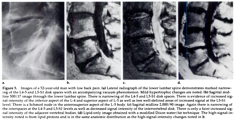 [MRI] Modic changes? : 네이버 블로그