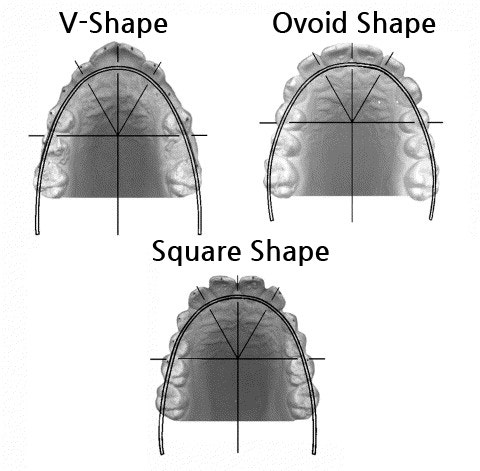[모형검사] 악궁(Dental Arch) 분석 : 네이버 블로그
