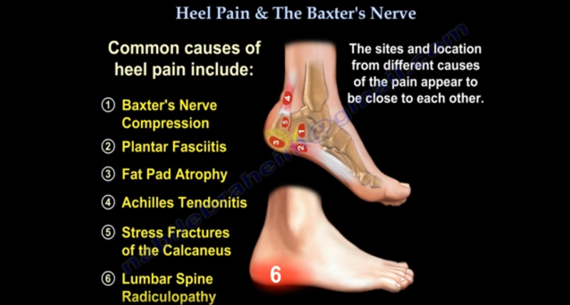 Heel Pain & The Baxter's Nerve 뒤꿈치 통증(발바닥 통증) 과 박스터신경 : 네이버 블로그