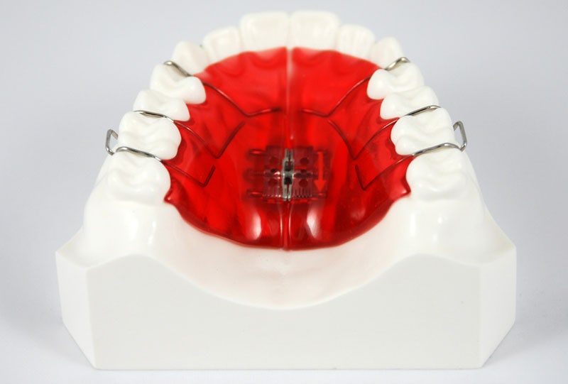 Expander, Schwarz / Quad-helix / Bonded / Hyrax: 악궁 확장 치아교정 장치 : 네이버 블로그