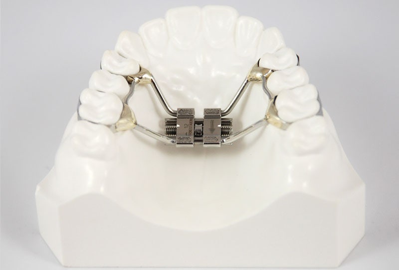 Expander, Schwarz / Quad-helix / Bonded / Hyrax: 악궁 확장 치아교정 장치 : 네이버 블로그