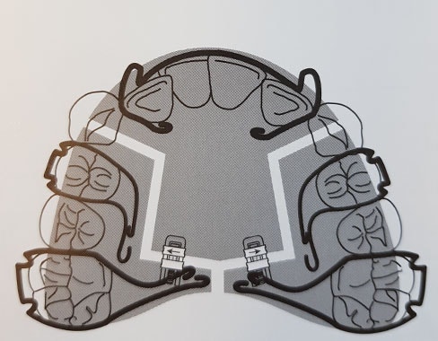 Sagittal Expander: 전후방 악궁 확장 치아교정 장치 : 네이버 블로그