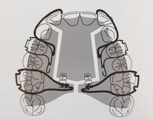 Sagittal Expander: 전후방 악궁 확장 치아교정 장치 : 네이버 블로그
