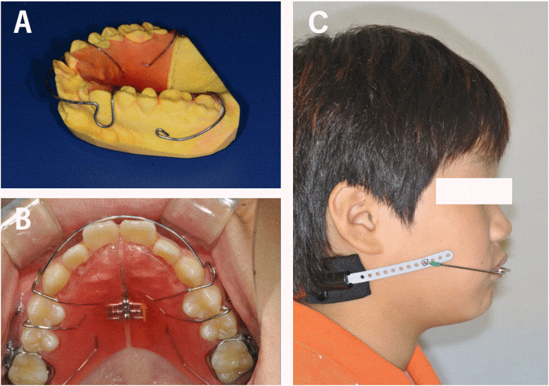 Expander, Schwarz / Quad-helix / Bonded / Hyrax: 악궁 확장 치아교정 장치 : 네이버 블로그