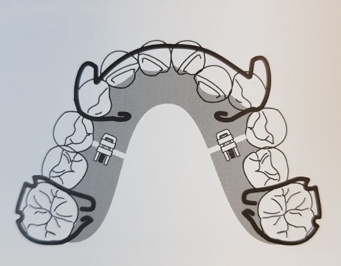 Sagittal Expander: 전후방 악궁 확장 치아교정 장치 : 네이버 블로그