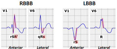 IM-cardio) EKG (정리중) : 네이버 블로그