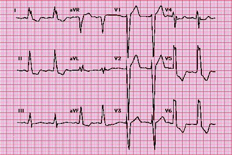 IM-cardio) EKG (정리중) : 네이버 블로그