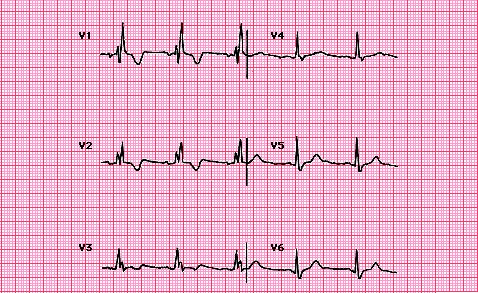 IM-cardio) EKG (정리중) : 네이버 블로그
