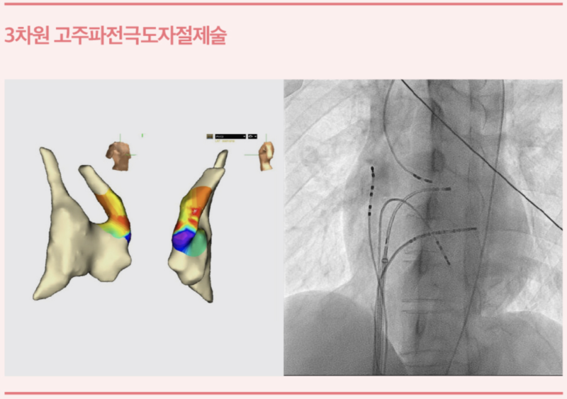 조기수축기외수축형 부정맥 심방조기수축 심실조기수축 네이버 블로그