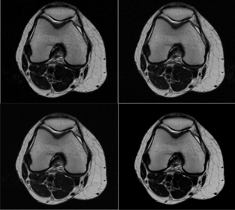 MRI의 NEX와 Band width : 네이버 블로그