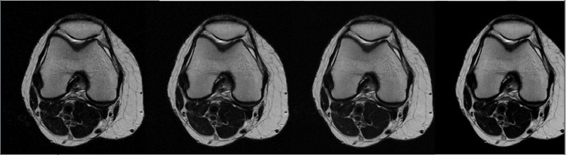 MRI의 NEX와 Band width : 네이버 블로그