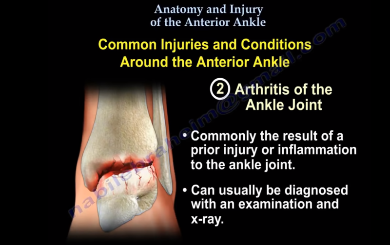 발목 해부학 및 통증 - 앞쪽 부위 ankle anatomy and pain : 네이버 블로그
