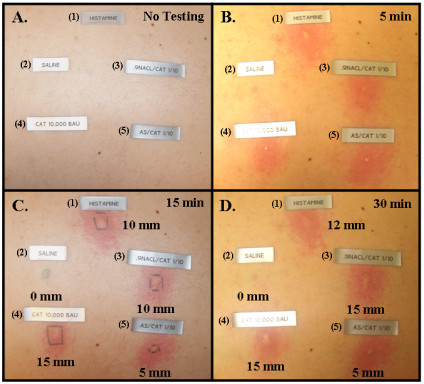 알레르기 진단방법(1) : 피부단자검사(skin prick test) : 네이버 블로그