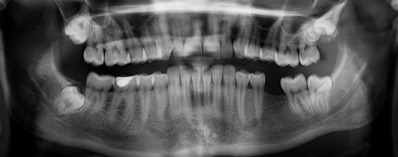 치과에서 촬영하는 엑스레이 X Ray 종류 치과 방사선 사진 파노라마 Cbct 등 By 닥터자일리톨
