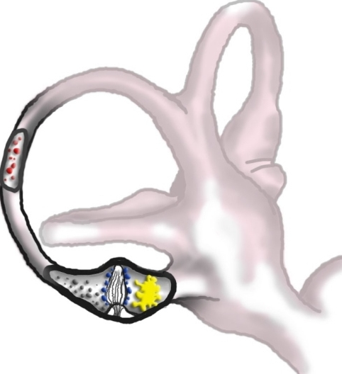 비정형적인 이석증 : 이석잼(Canalith jam) - 부산 핑이비인후과 : 네이버 블로그