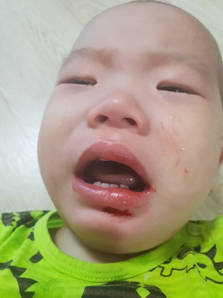 아기얼굴찢어졌을때 부산k성형외과병원에서 얼굴 입술밑 봉합수술했어요 네이버 블로그