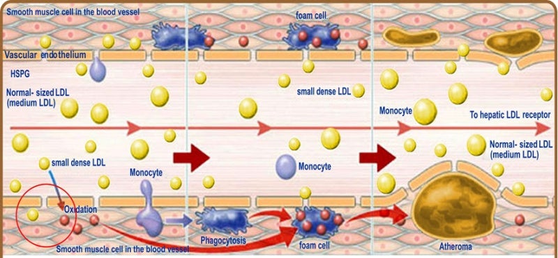 sdLDL(=Small Dense LDL), sdLDL-Cholesterol : 네이버 블로그